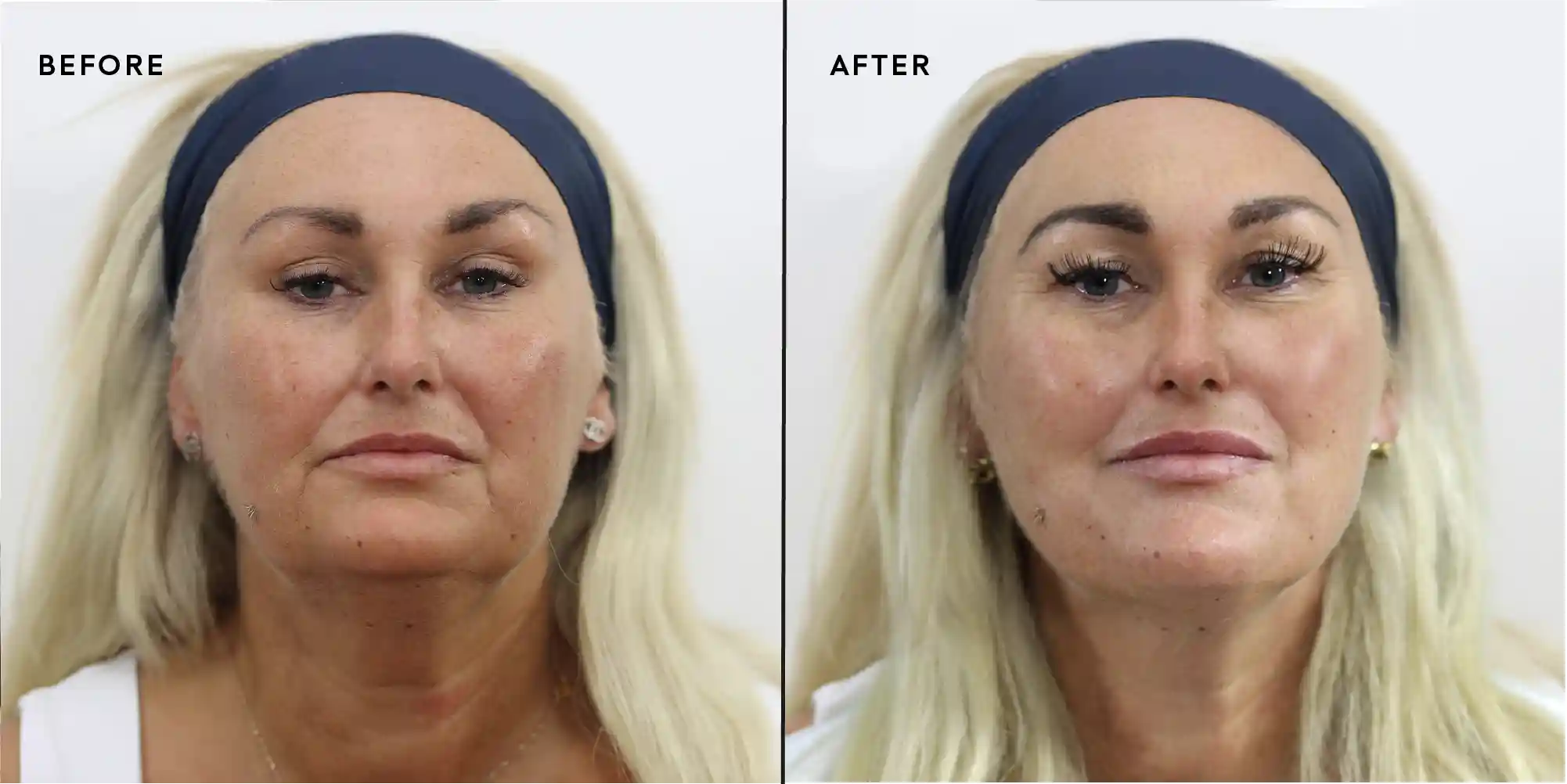 What are Thread Lift treatments? Everything you need to know.